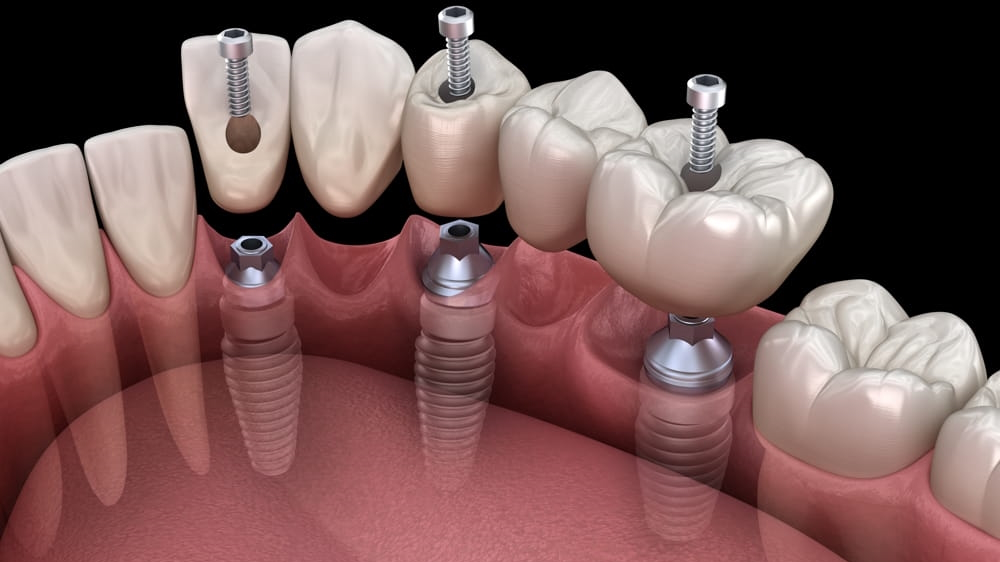 Implantodontia — Simas Odontologia